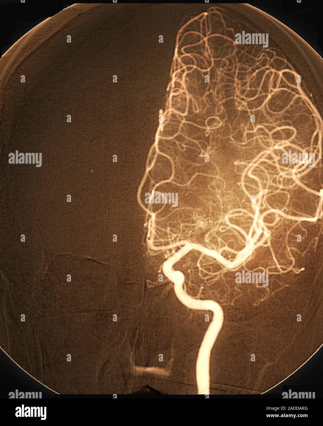 Brain arteries after stroke treatment. Coloured angiogram of arteries ...