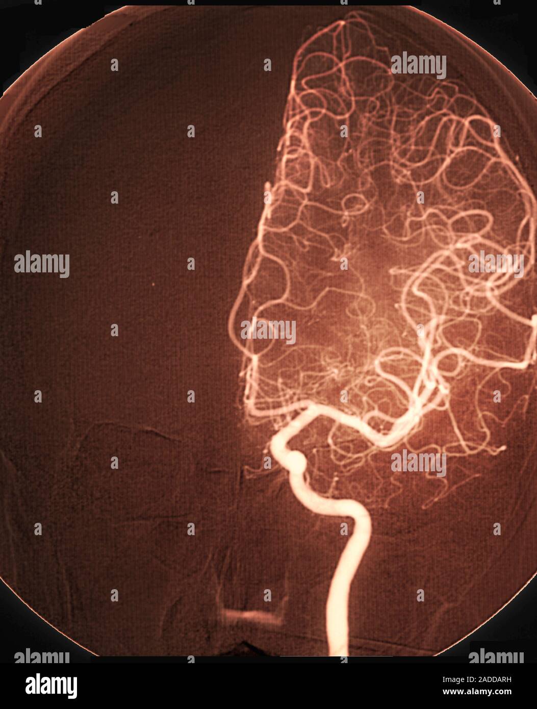 Brain arteries after stroke treatment. Coloured angiogram of arteries ...
