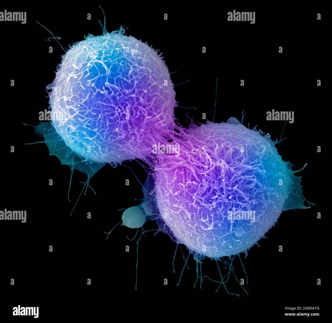 Dividing cancer cells. Coloured scanning electron micrograph (SEM) of ...