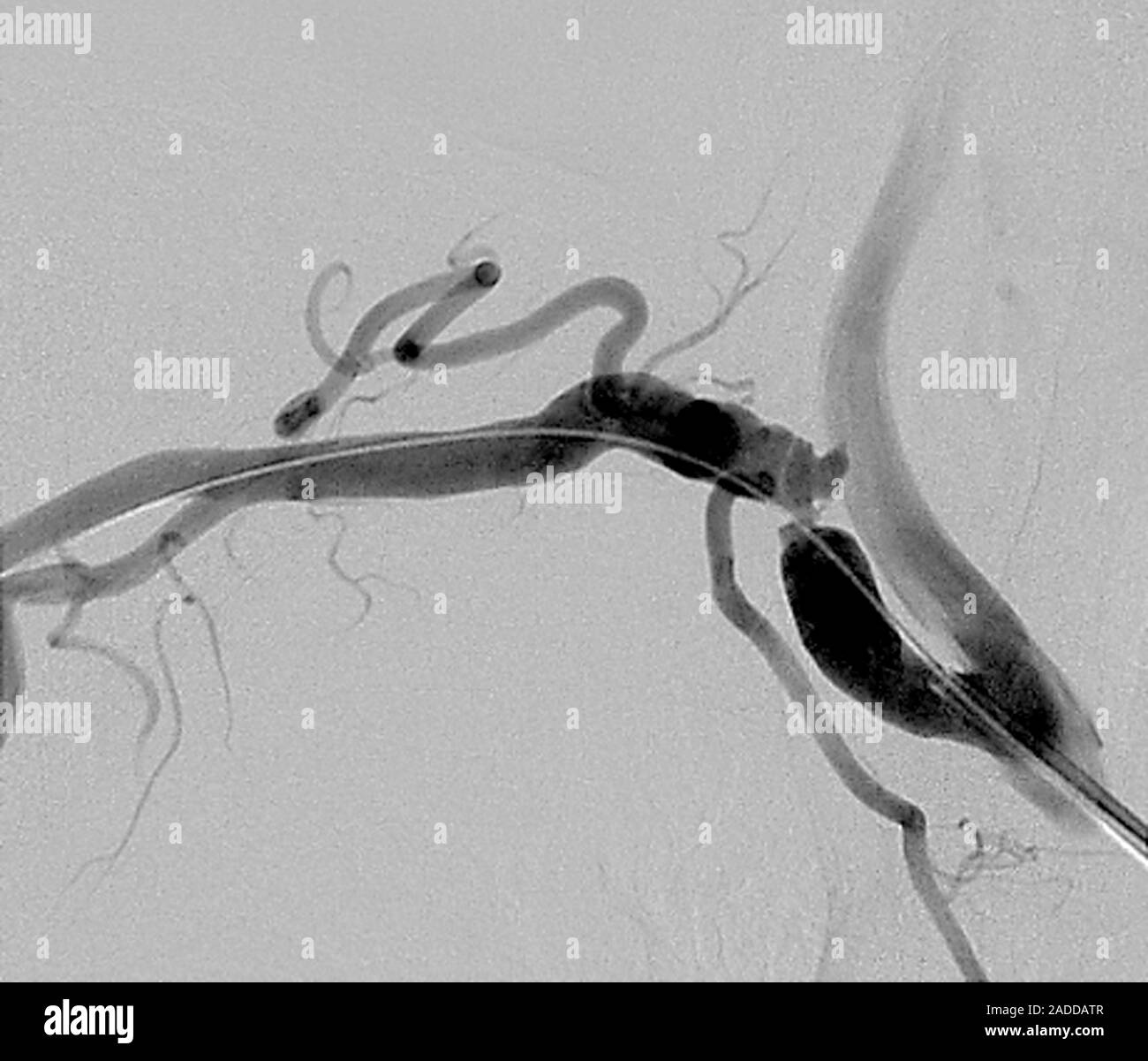 Treatment of reduced blood flow in polyvascular disease. Angiogram of a ...