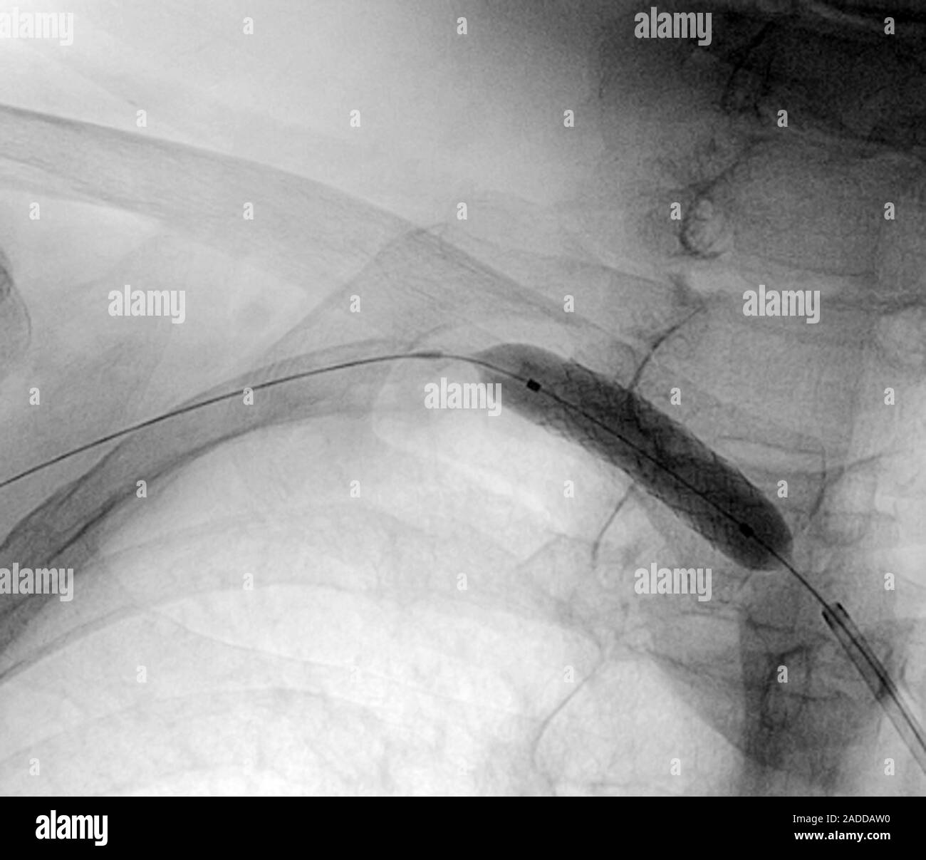 Treatment of reduced blood flow in polyvascular disease. Angiogram of ...