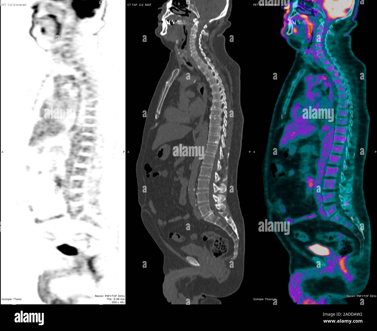 Colon cancer scans. Medial sagittal positron emission tomography (PET ...