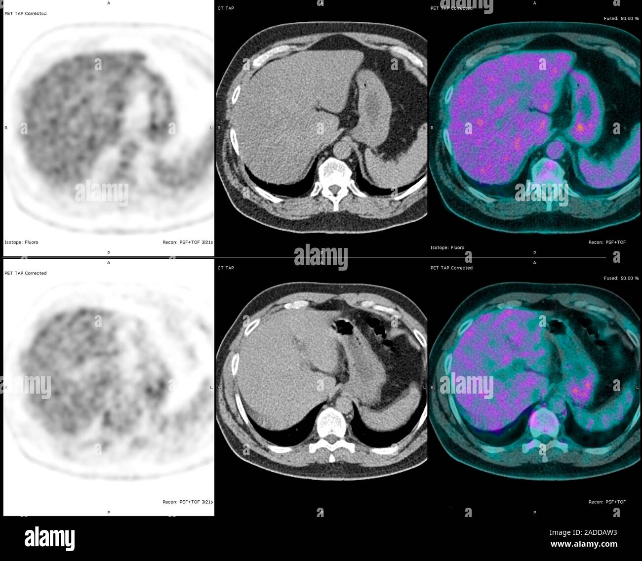 Colon cancer scans. Axial positron emission tomography (PET) and ...