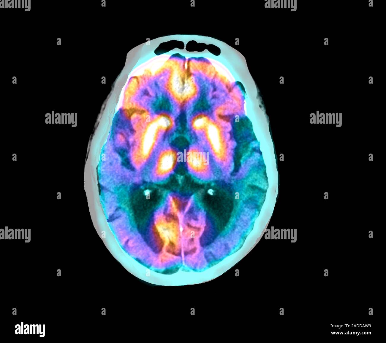 Alzheimer's disease. Coloured combined positron emission tomography ...