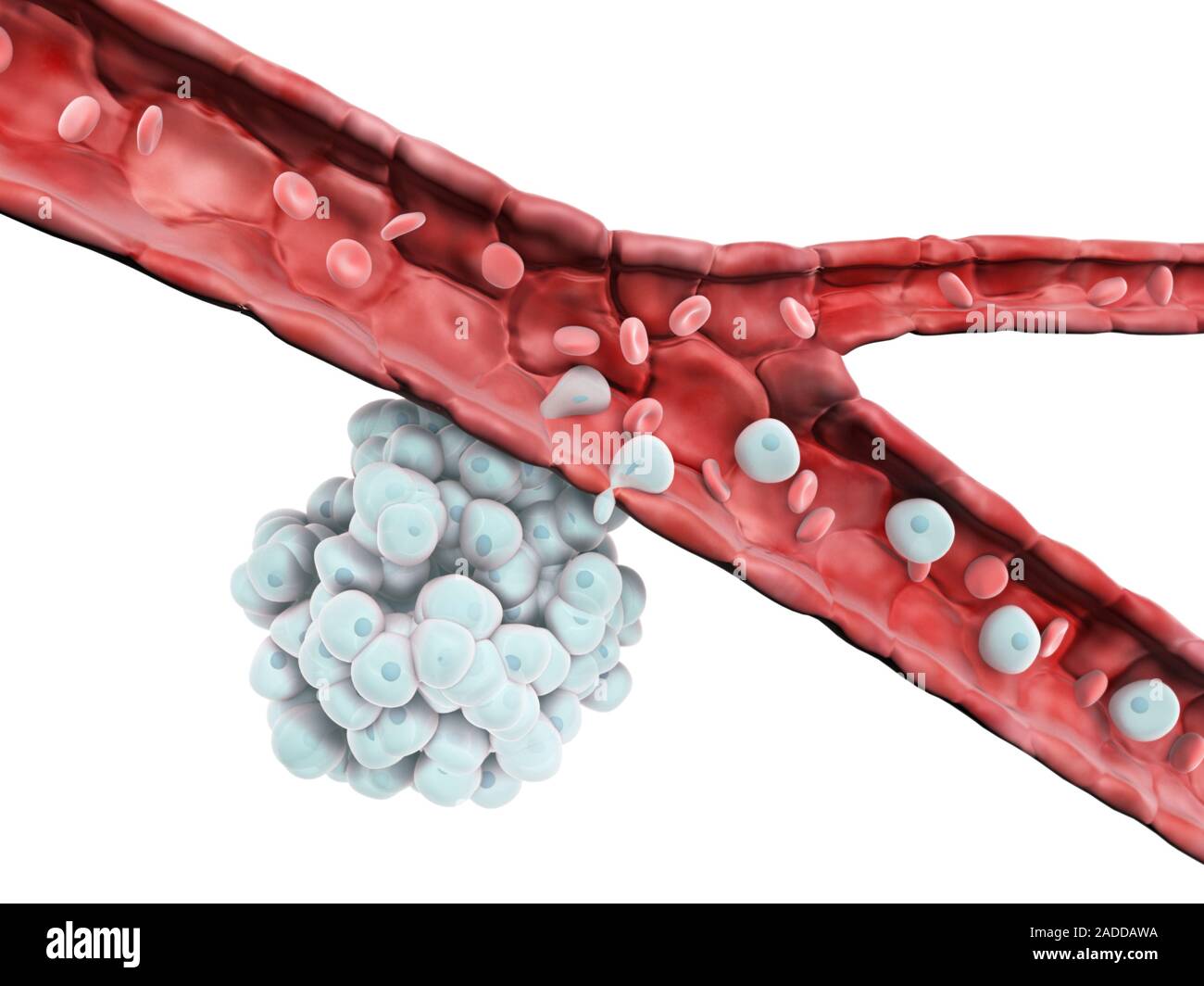 Cancer cells spreading. Illustration showing cancerous cells (blue ...
