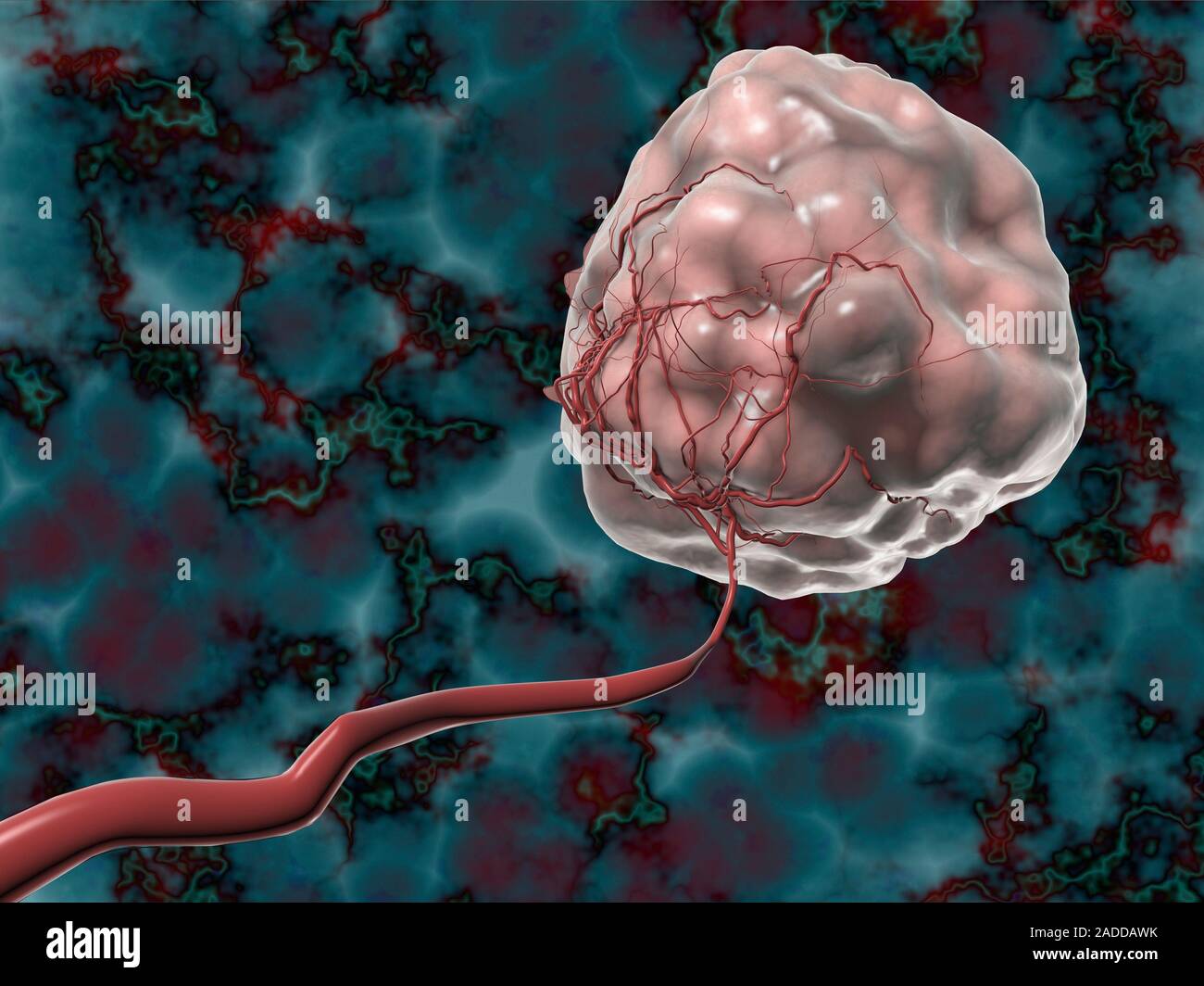 Tumour with a blood supply. Illustration showing a malignant (cancerous ...