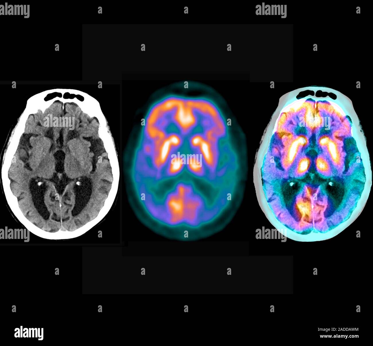 Alzheimer's disease. Coloured positron emission tomography (PET, centre ...