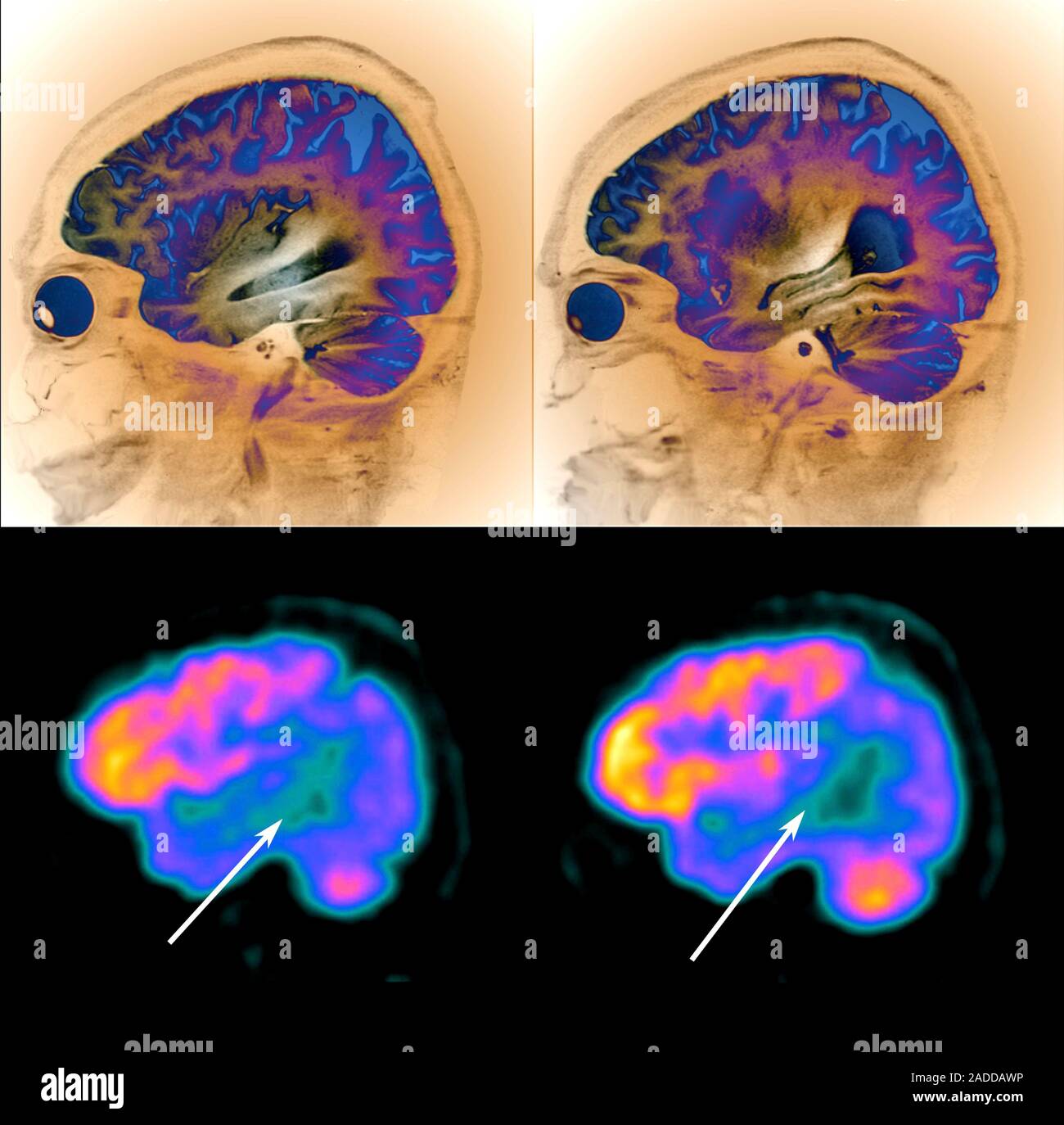 Alzheimer's disease. Coloured sagittal magnetic resonance imaging (MRI ...