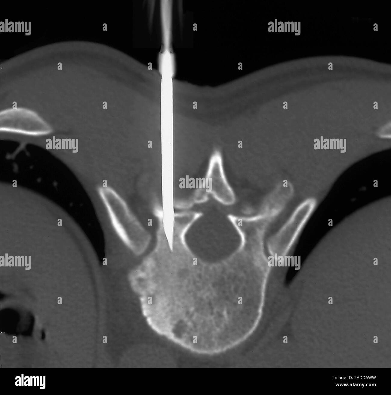 Treatment of secondary bone cancer in the spine. Axial computed ...