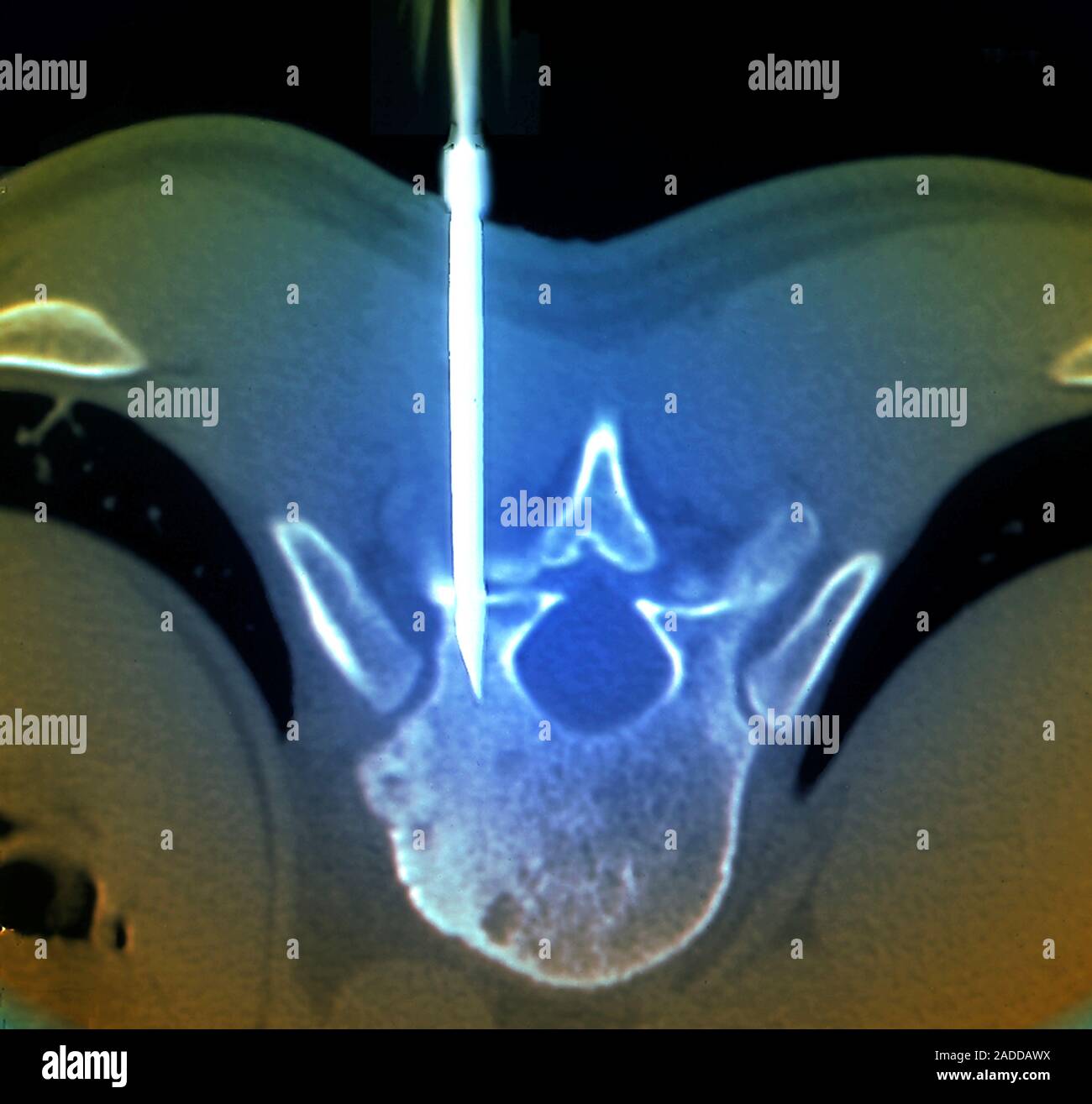 Treatment of secondary bone cancer in the spine. Coloured axial ... Treatment of secondary bone cancer in the spine. Coloured axial ...