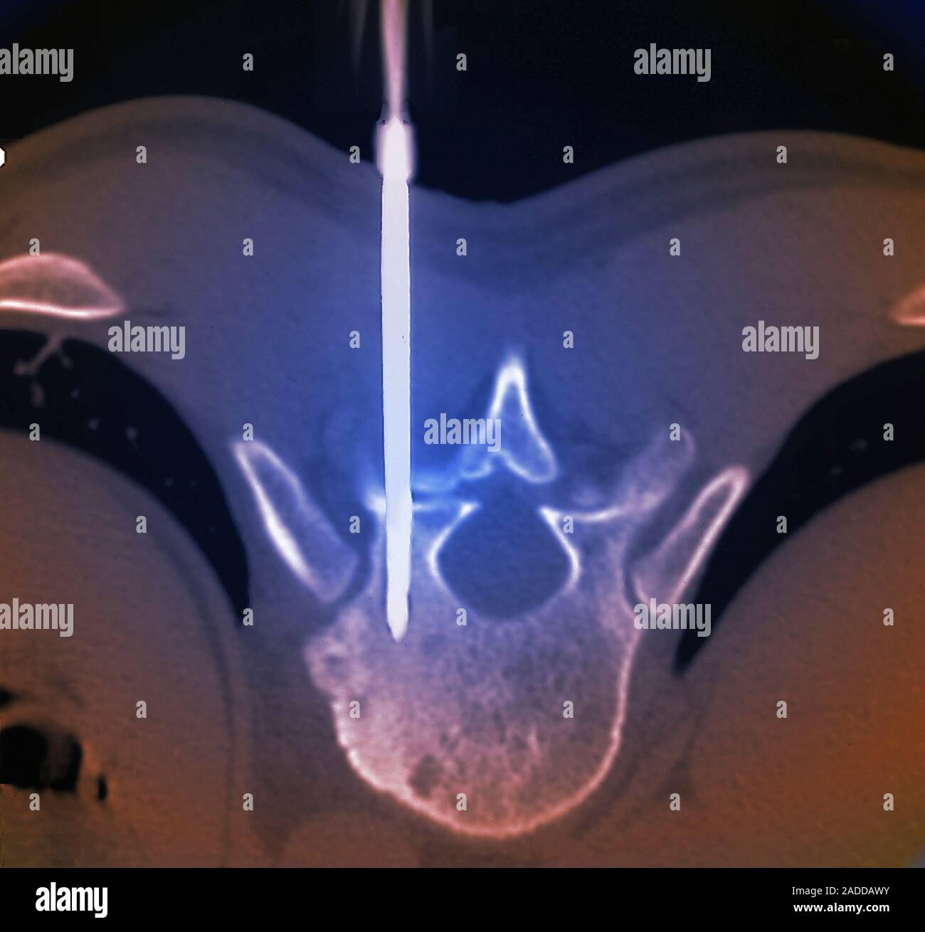 Treatment of secondary bone cancer in the spine. Coloured axial ...