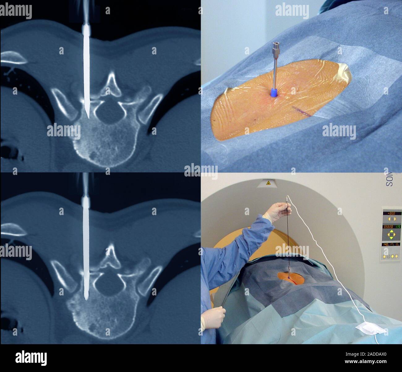 Treatment of secondary bone cancer in the spine. Surgical views (right ...