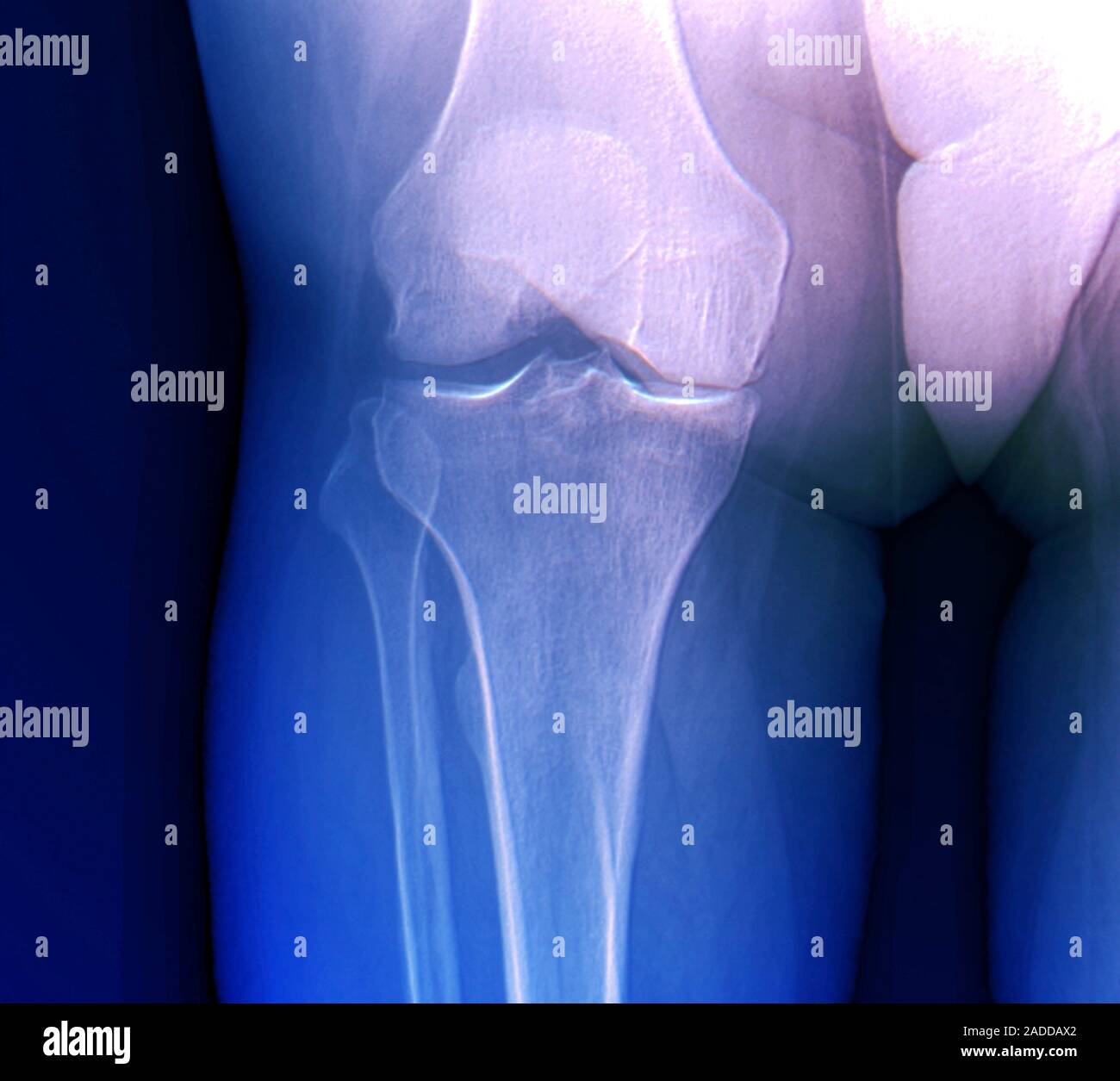 Knee osteoarthritis in obesity. Coloured frontal X-ray of the right ...