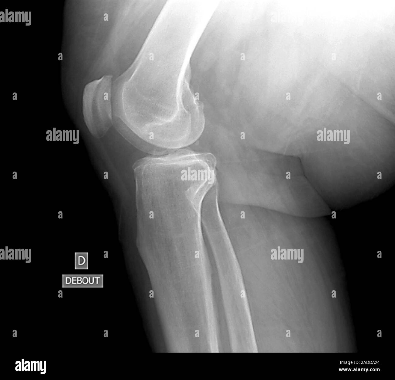 Knee osteoarthritis in obesity. Lateral X-ray of the right knee of a 48 ...