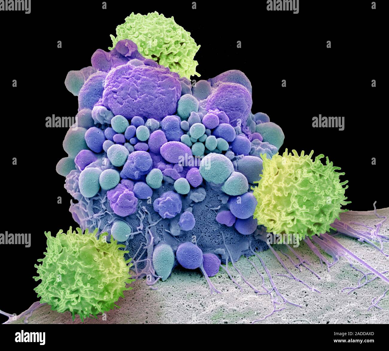 T-cells and brain cancer cell. Composite coloured scanning electron ...
