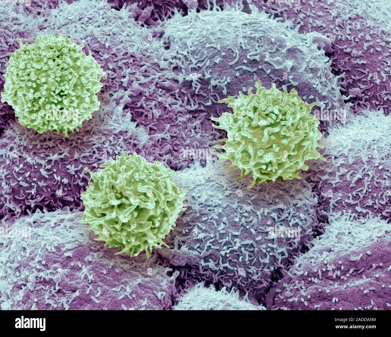 T Cells And Prostate Cancer Cells Composite Coloured Scanning Electron Micrograph Sem Of T