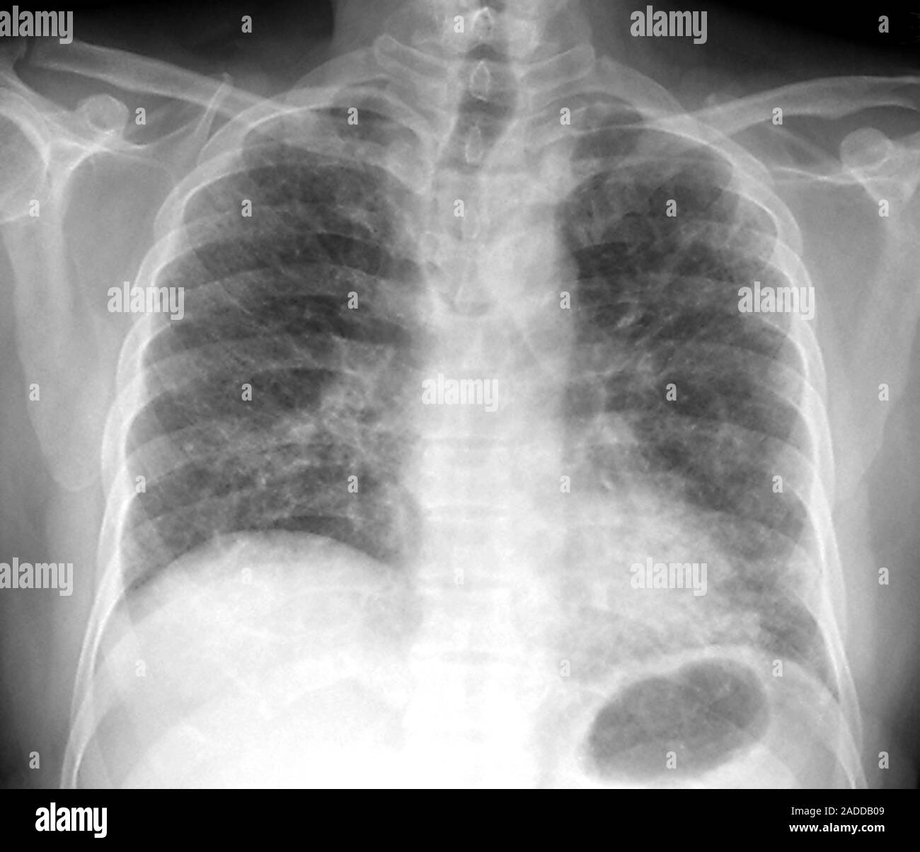 Pulmonary fibrosis. Frontal X-ray of the chest of a 58-year-old man ...