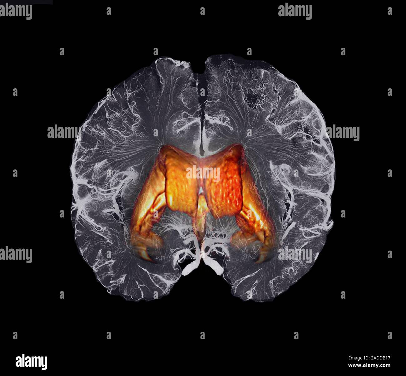 Human brain ventricles. Coloured 3D computed tomography (CT) scan of ...