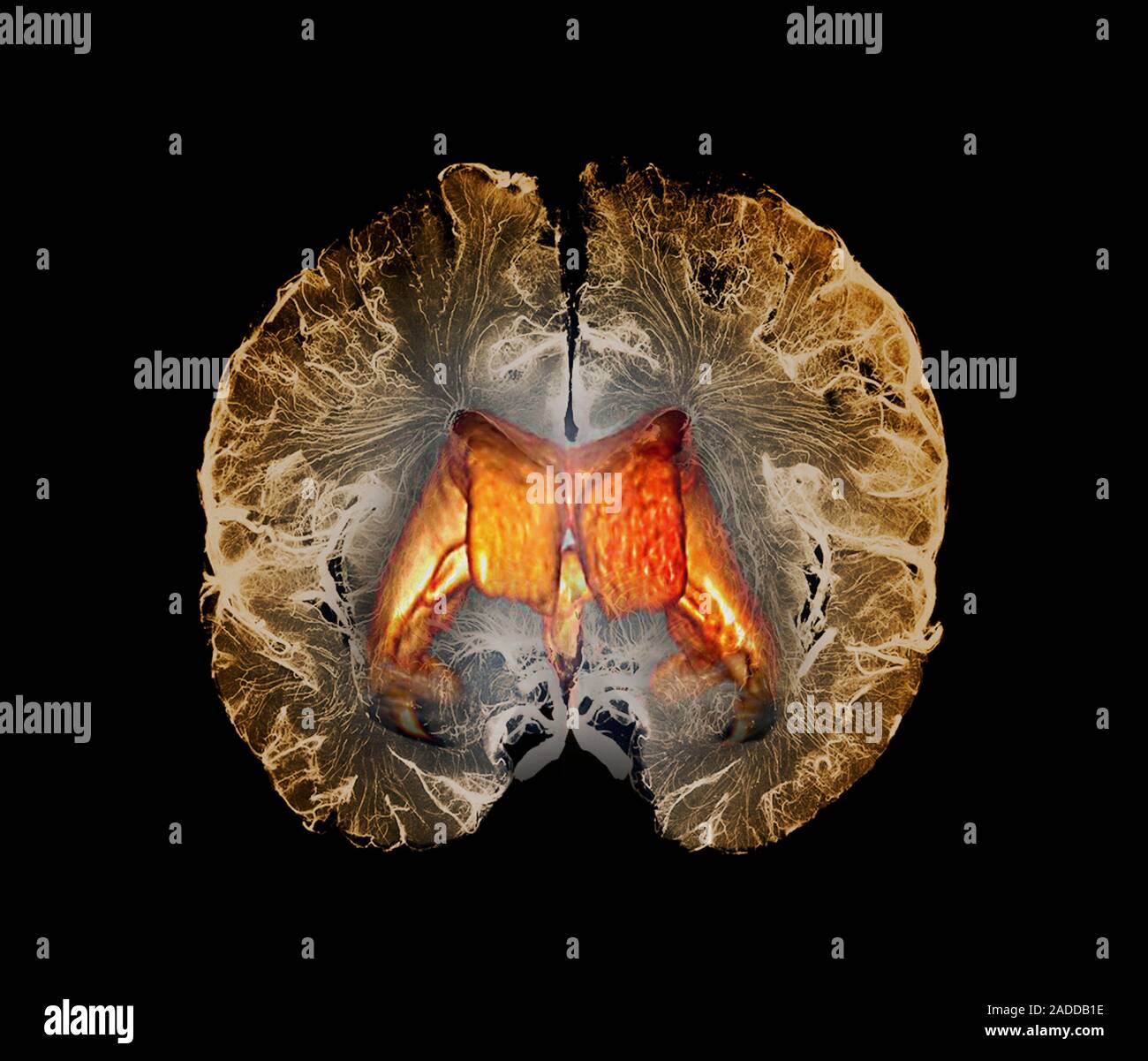 Human brain ventricles. Coloured 3D computed tomography (CT) scan of ...