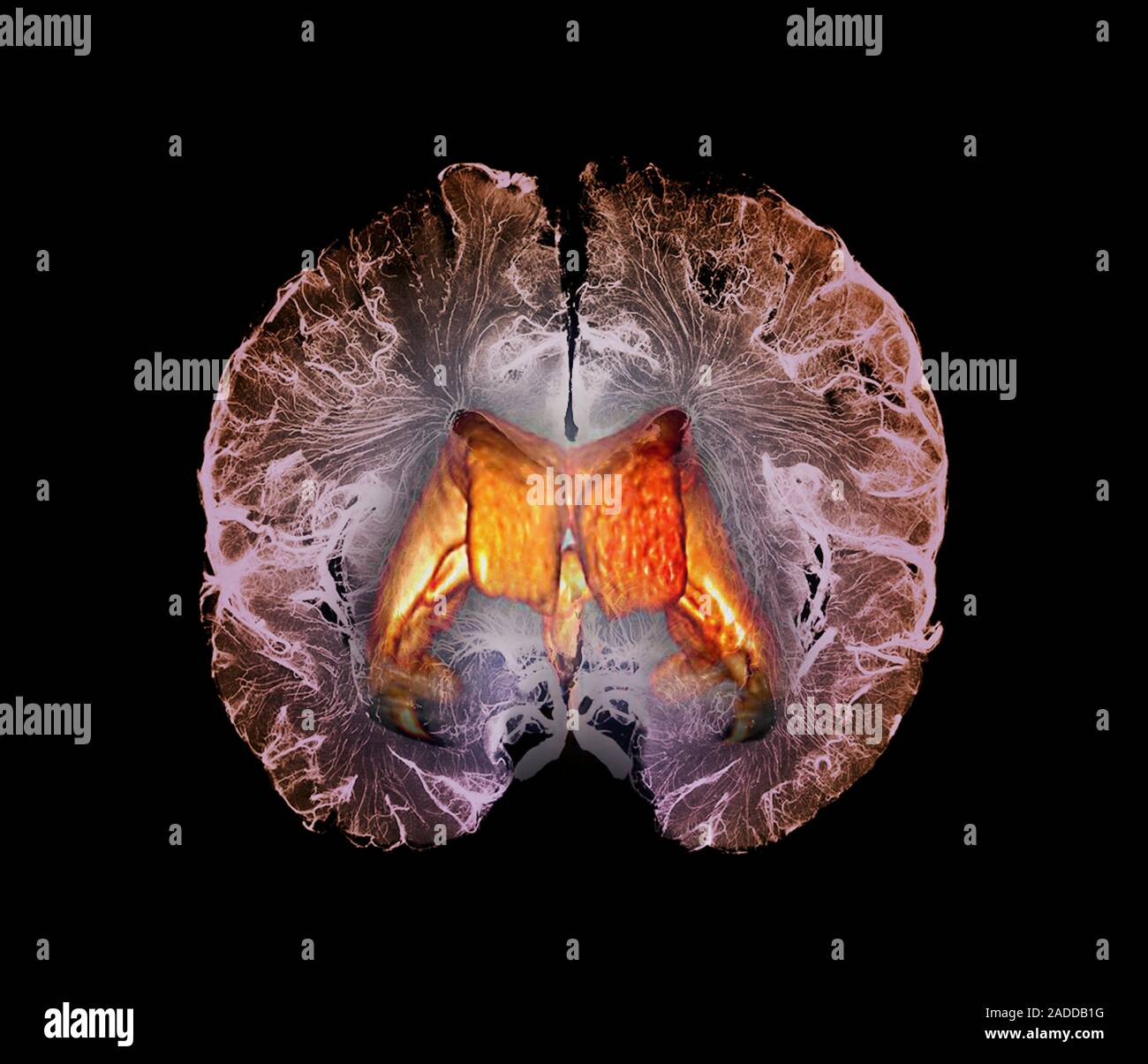 Human brain ventricles. Coloured 3D computed tomography (CT) scan of ...