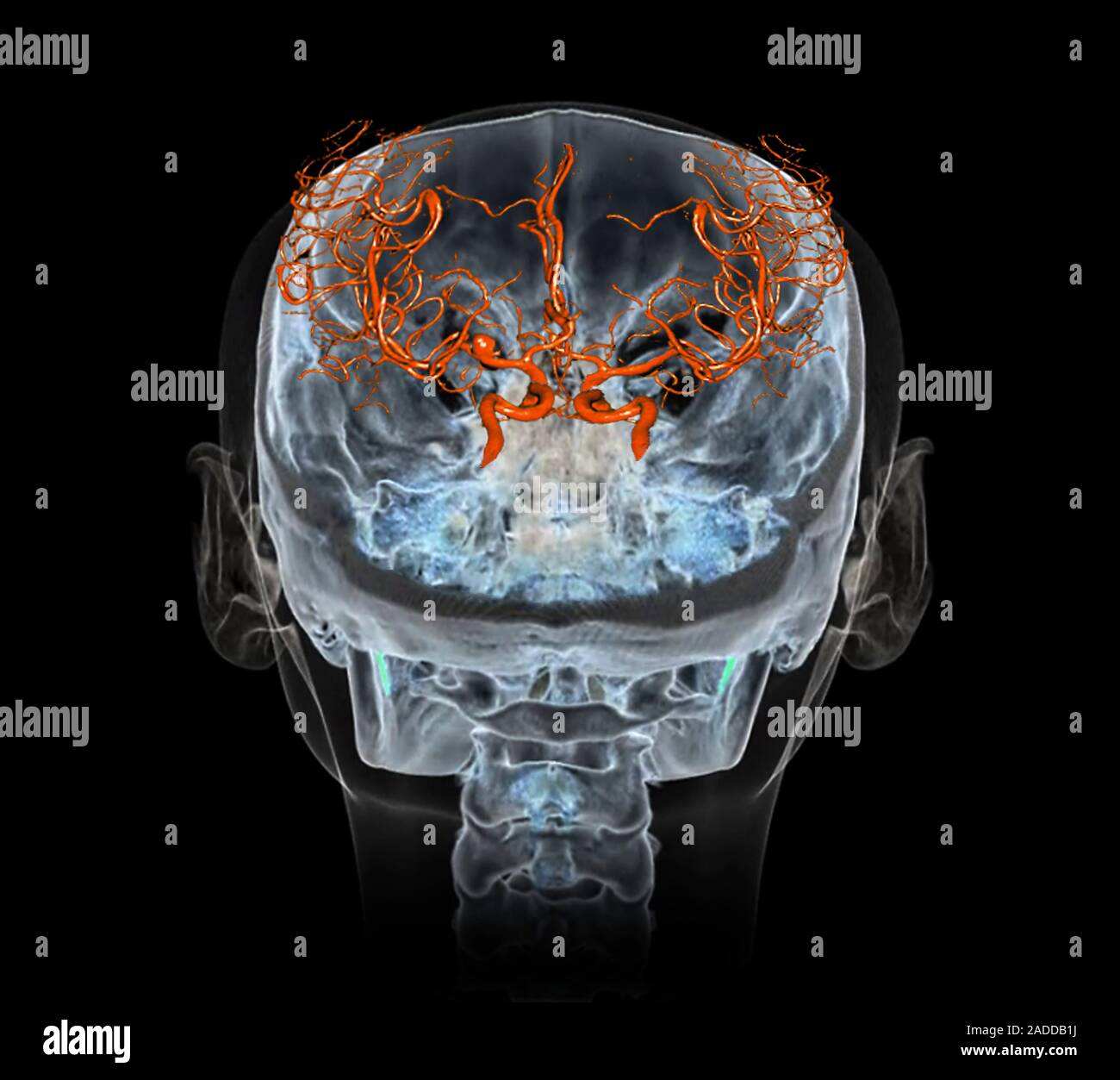 Cerebral aneurysm. Posterior 3D computed tomography (CT) angiogram scan of an aneurysm (swelling ...