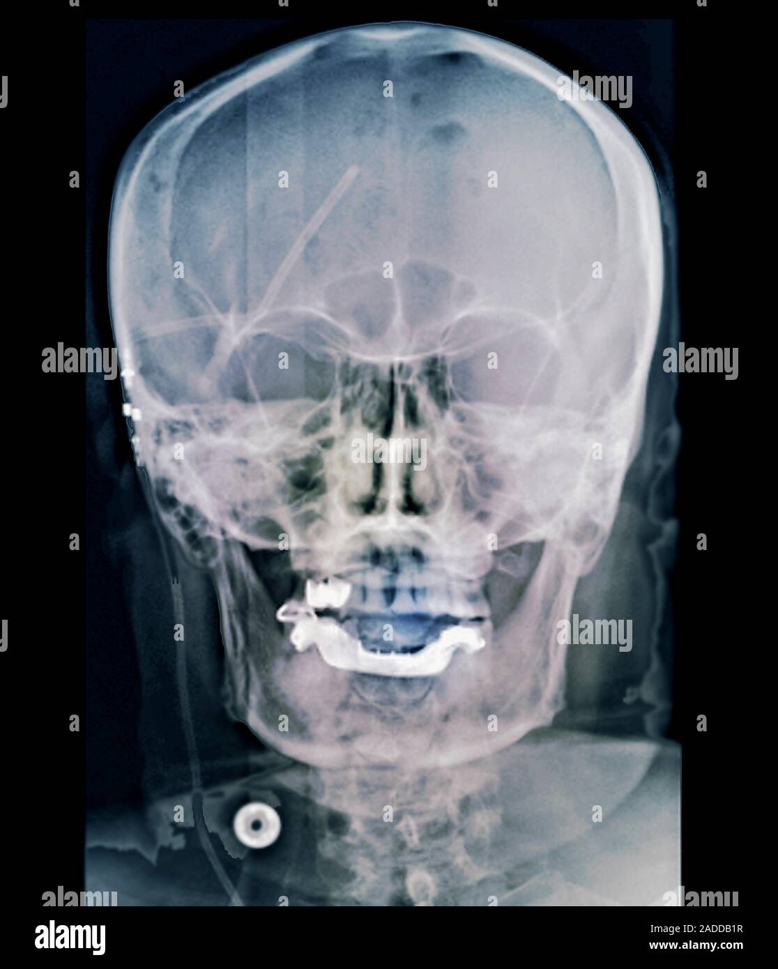 External ventricular drain. Frontal X-ray of the head of a 72-year-old ...
