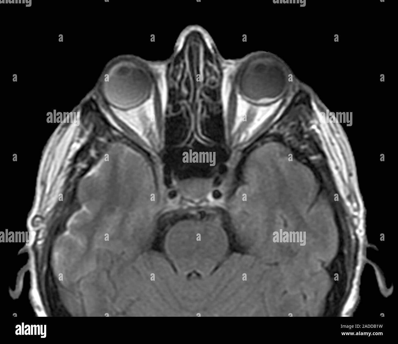 Retinal detachment. Axial magnetic resonance imaging (MRI) scan through ...