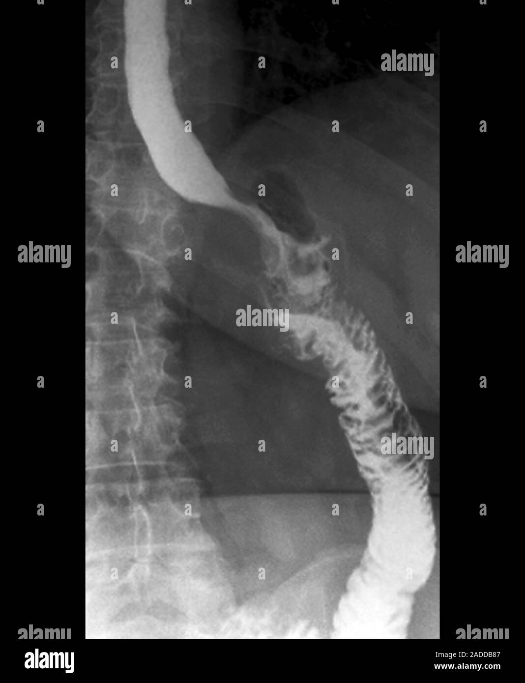 Gastric bypass. Frontal X-ray of the digestive system of an obese 50 ...