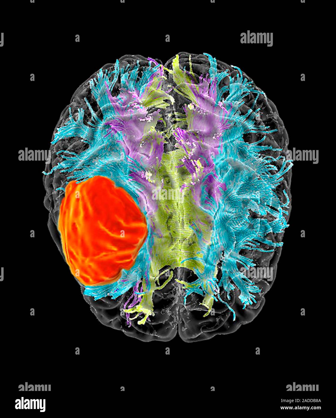 Glioblastoma brain cancer. Coloured 3D diffusion tensor imaging (DTI) magnetic resonance imaging ...