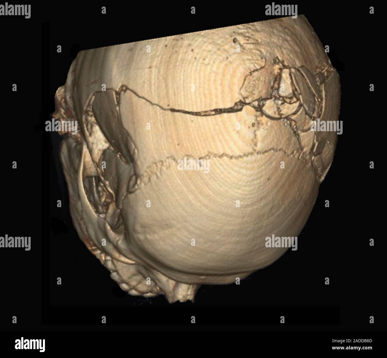 Skull fractures. Coloured 3D computed tomography (CT) scan of the skull ...