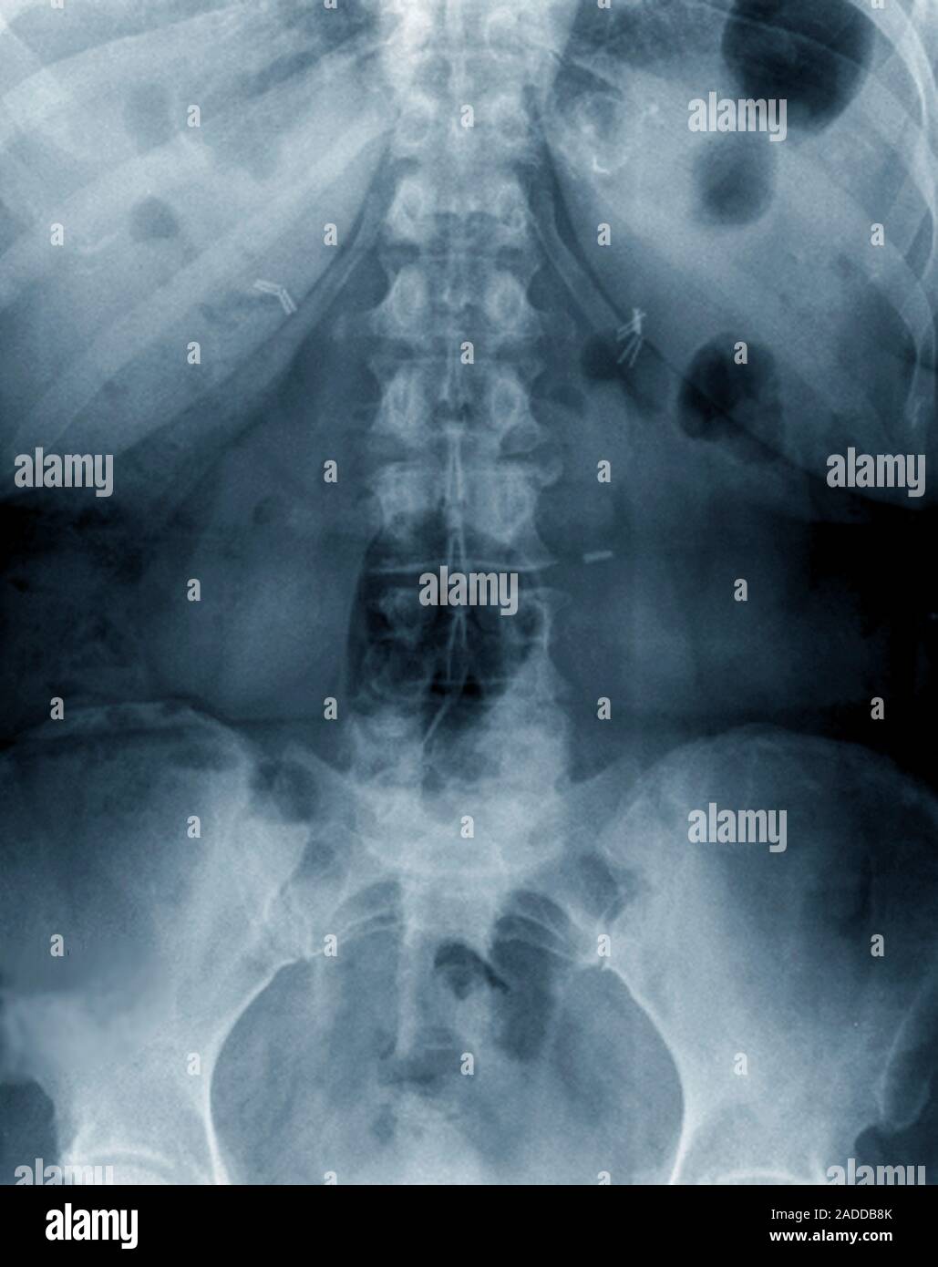 Gastric bypass. Frontal X-ray of the digestive system of an obese 52 ...