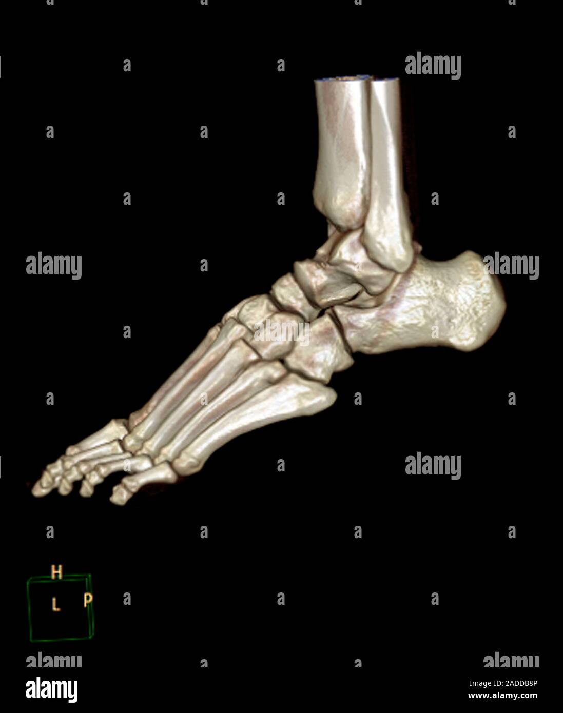 Human foot. 3D coloured computed tomography (CT) scan of the bones of ...
