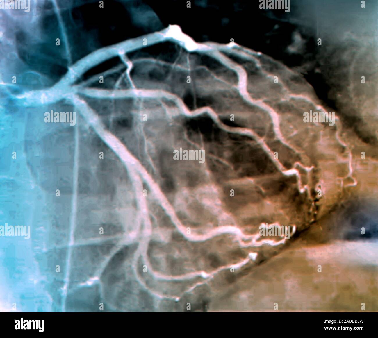Left coronary artery network. Coloured coronarography (contrast medium ...