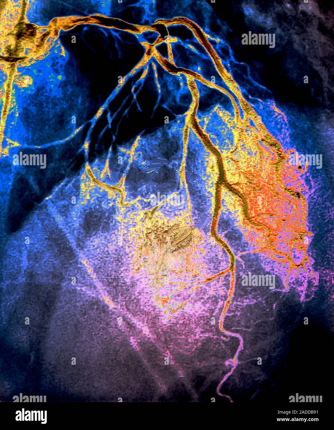 Left coronary artery network. Coloured coronarography (contrast medium ...