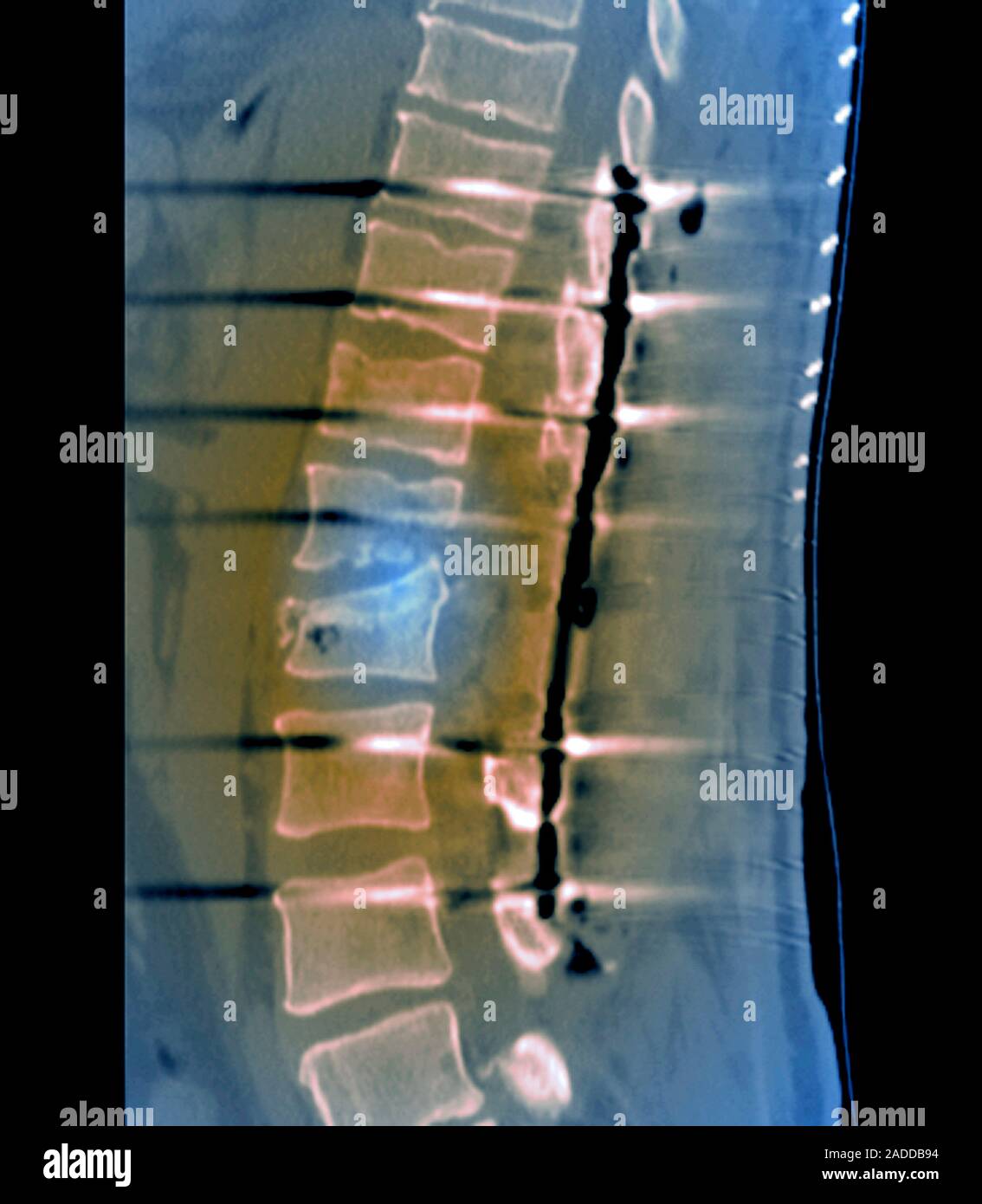 Spinal fusion surgery for broken back. Coloured sagittal computed ...
