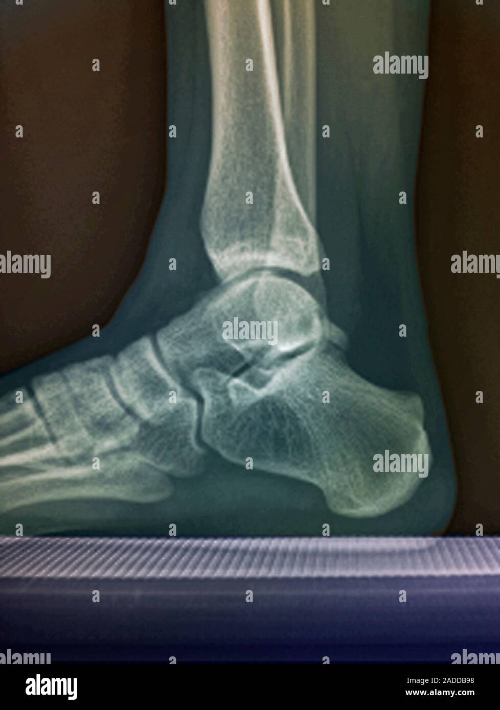 Human foot and ankle. Coloured lateral X-ray of the bones of the foot ...