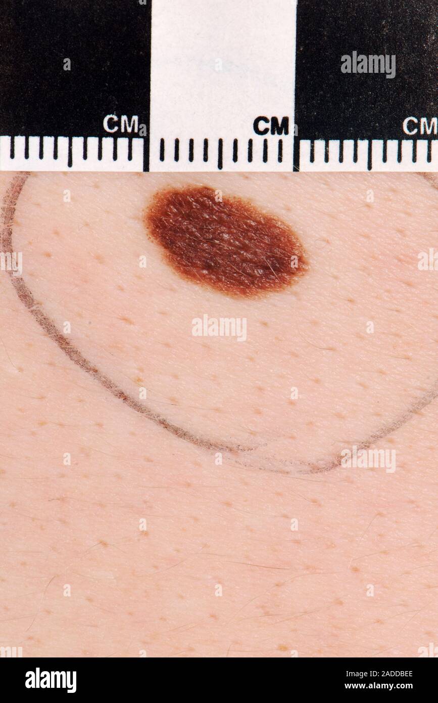 Atypical mole being measured on a 23-year-old man's back. Atypical ...