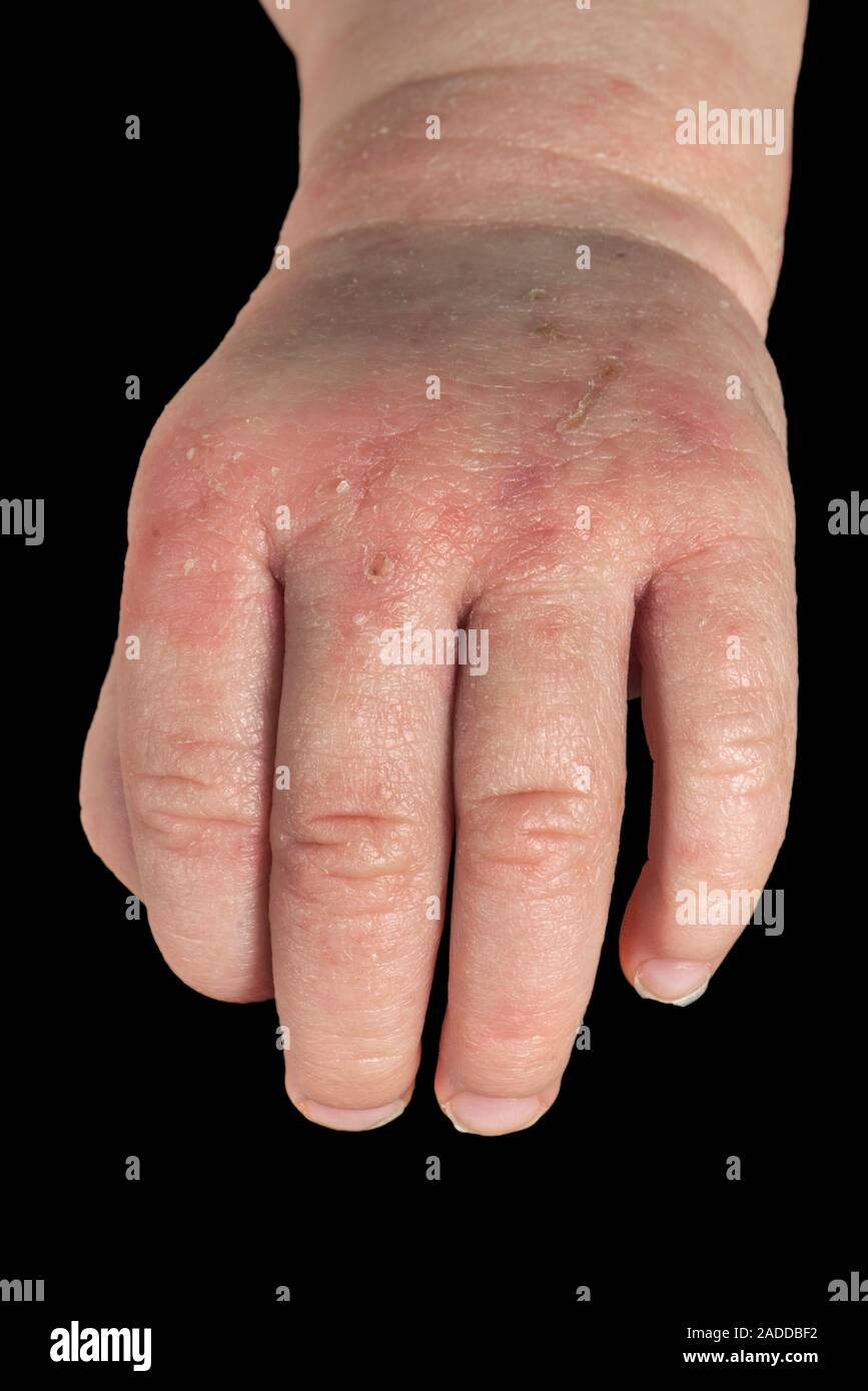 Atopic eczema on a baby's hand. Atopic eczema affecting areas of skin ...