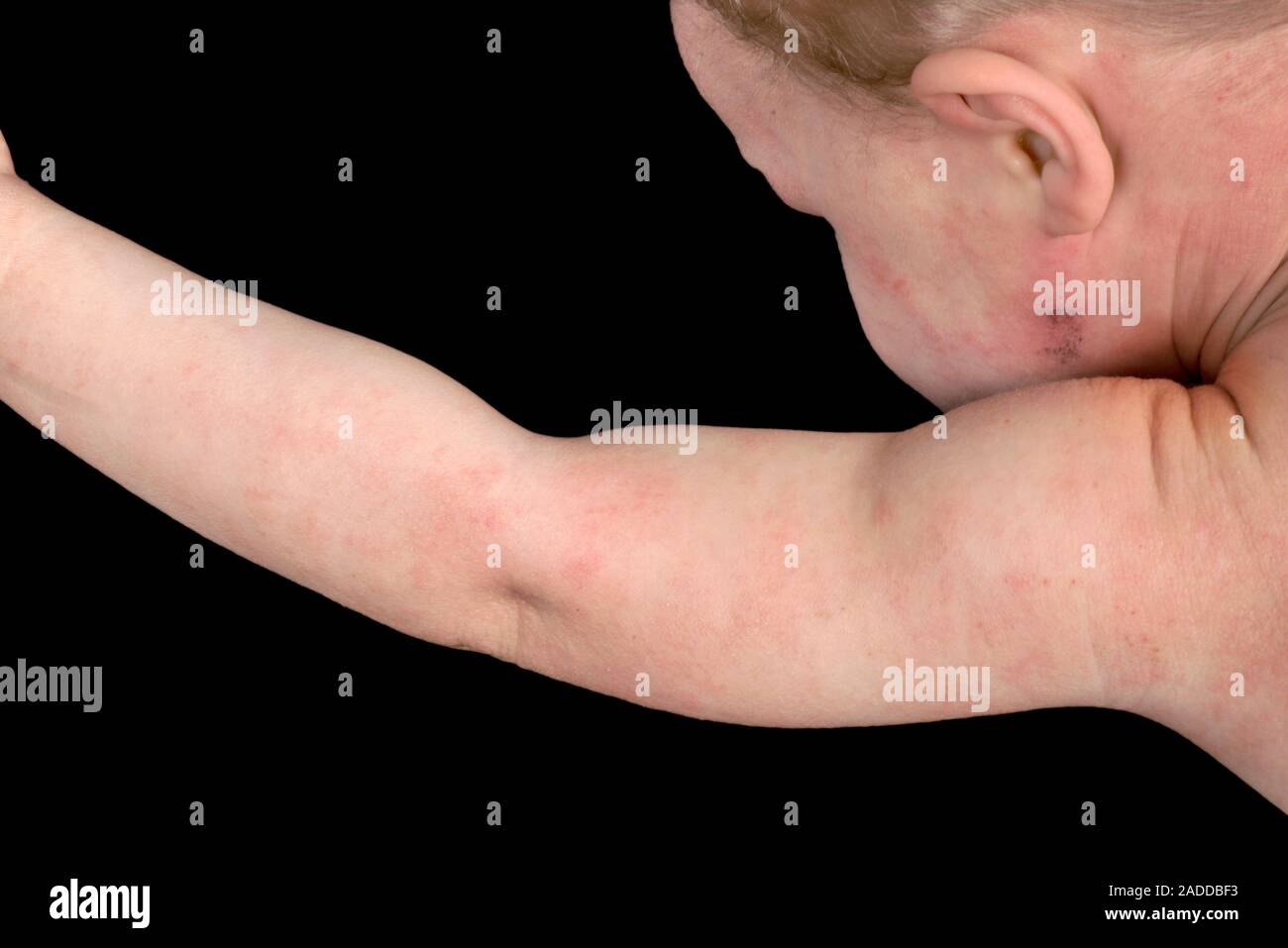 Atopic eczema on a baby's arm. Atopic eczema affecting areas of skin on ...