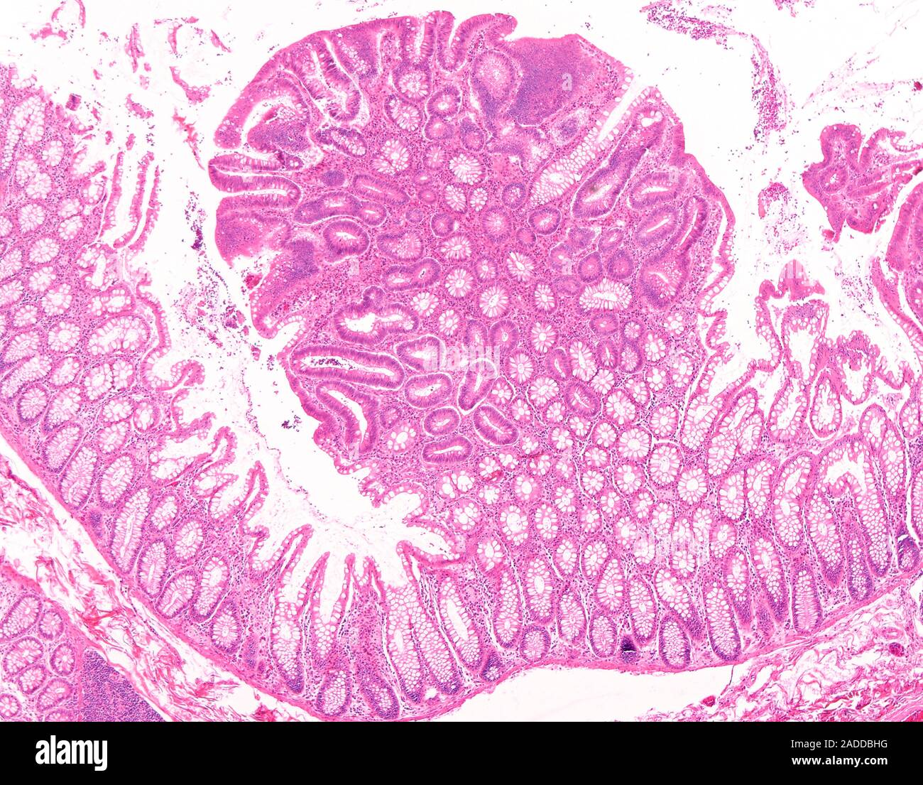 Tubular colon polyp, light micrograph. This specimen shows tissue from ...