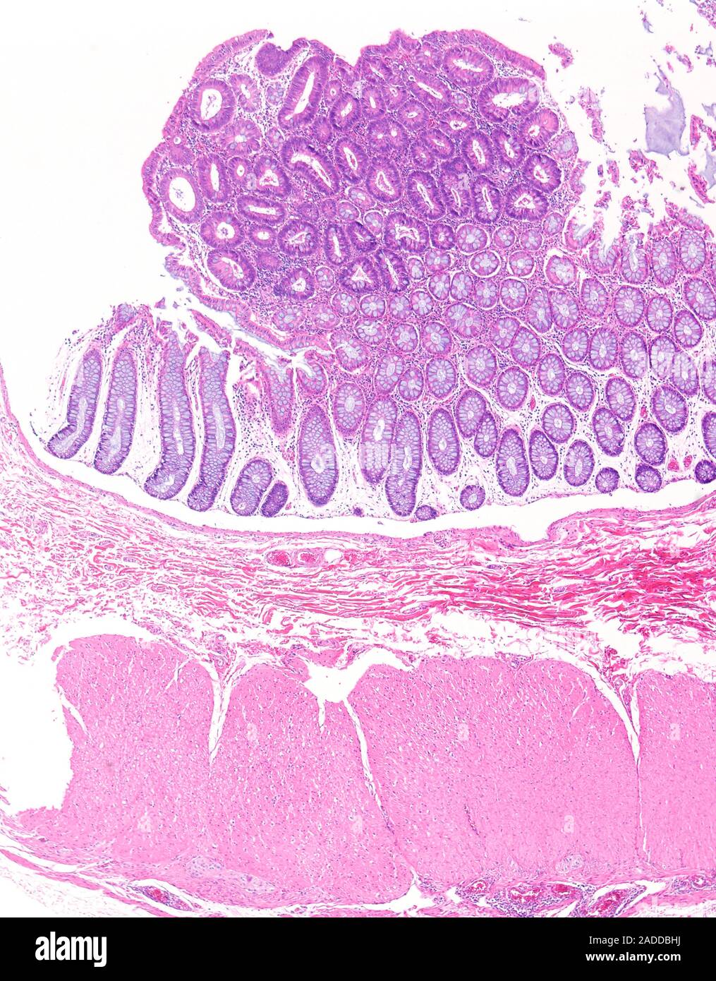 Tubular colon polyp, light micrograph. This specimen shows tissue from ...