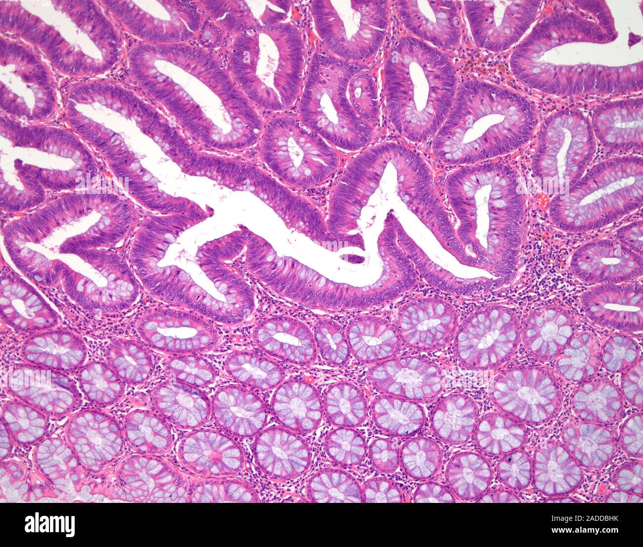 Tubular colon polyp, light micrograph. This specimen shows tissue from ...