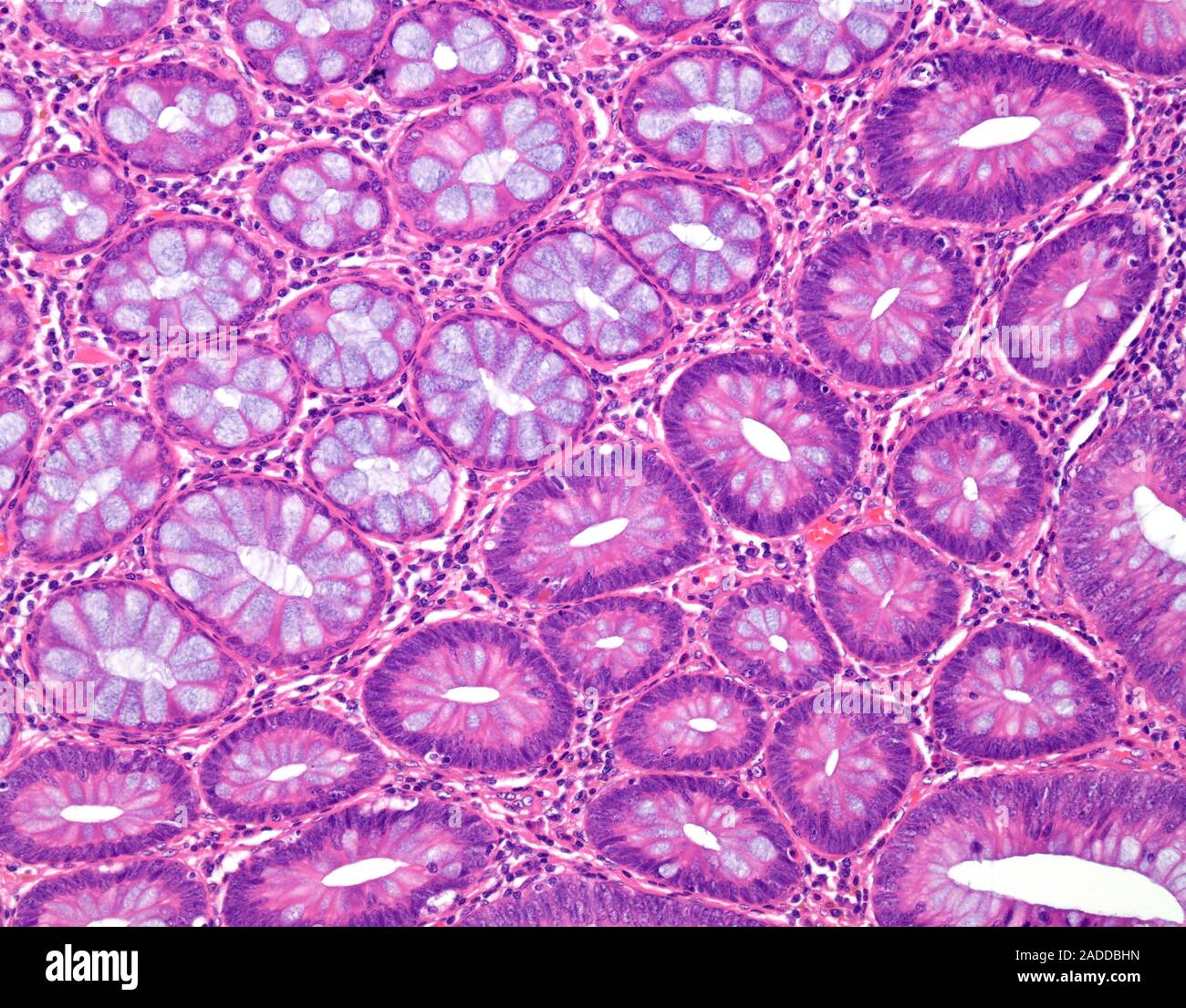 Tubular colon polyp, light micrograph. This specimen shows tissue from ...