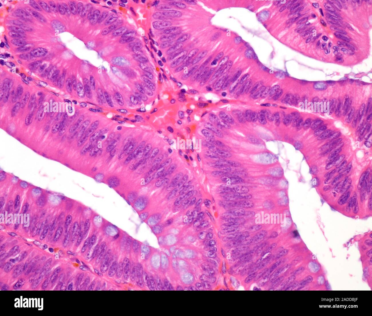 Tubular colon polyp, light micrograph. This specimen shows tissue from ...