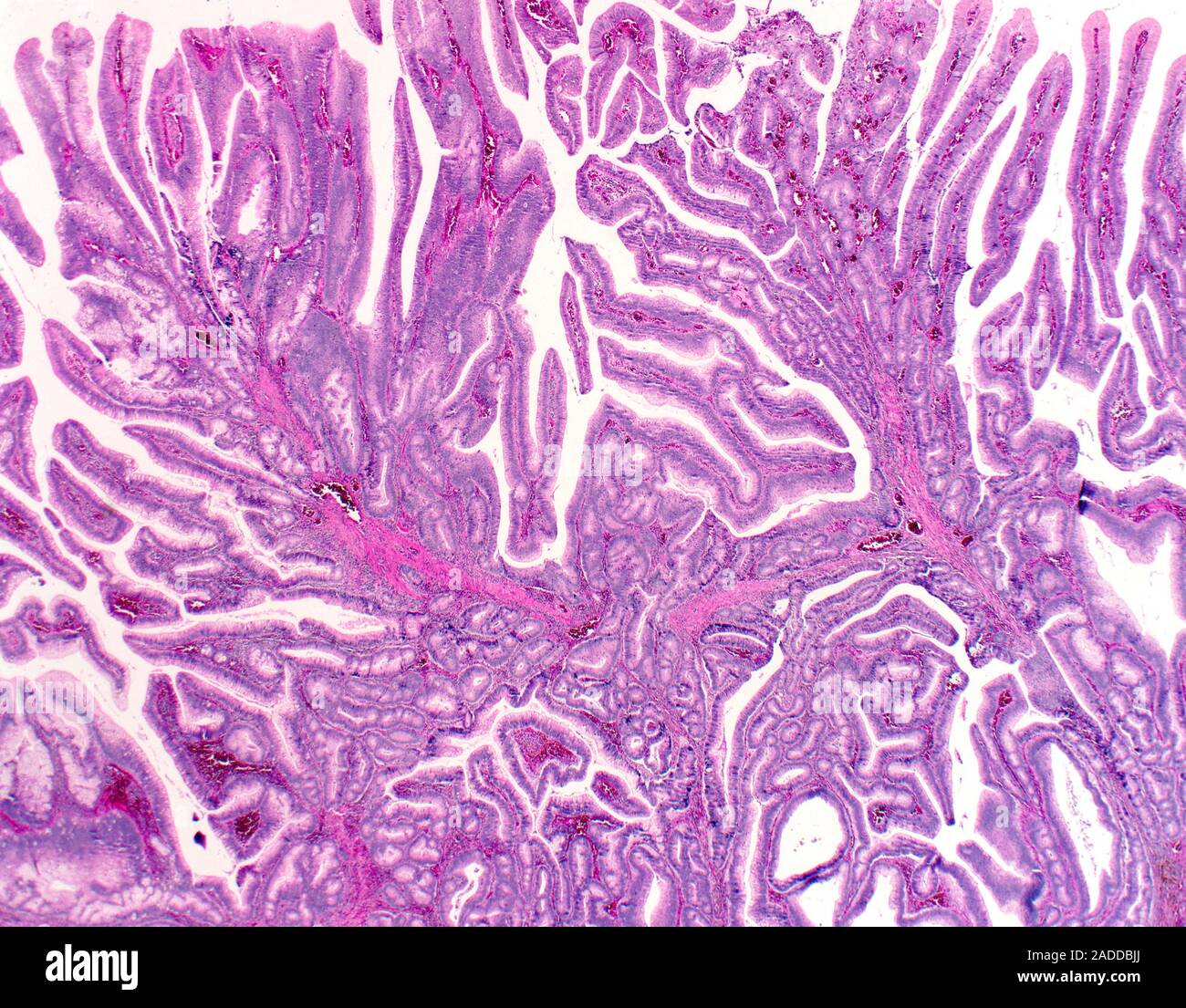 Tubulovillous colon polyp, light micrograph. This specimen shows tissue ...