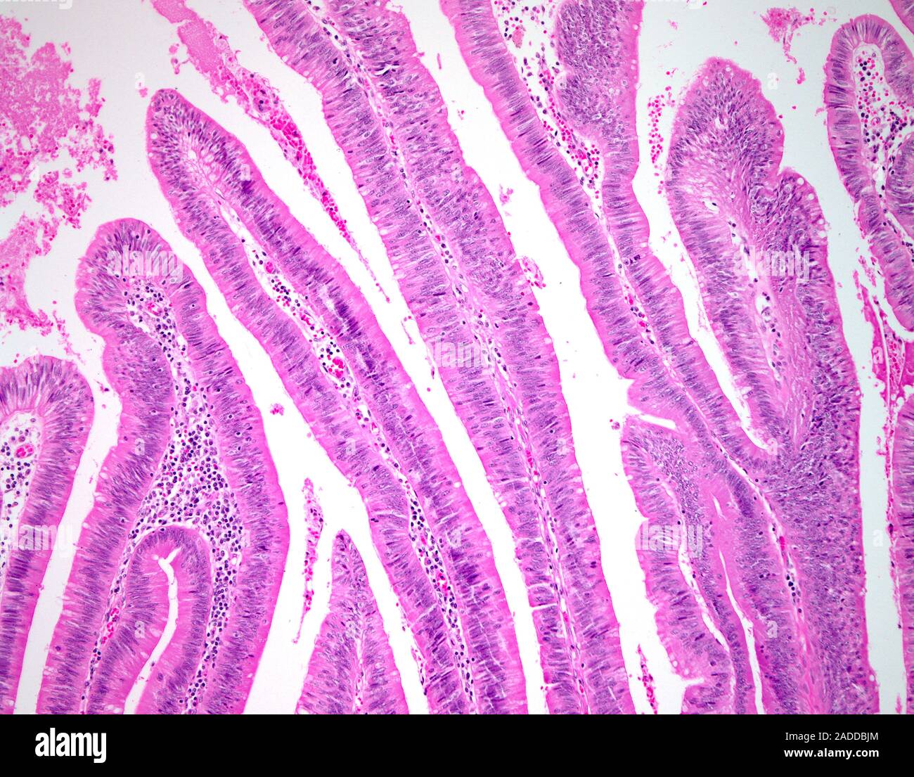 Villous Colon Polyp Light Micrograph This Specimen Shows Tissue From