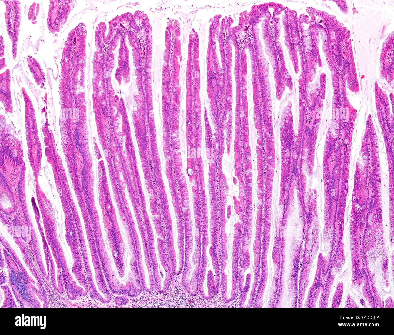 Villous colon polyp, light micrograph. This specimen shows tissue from ...