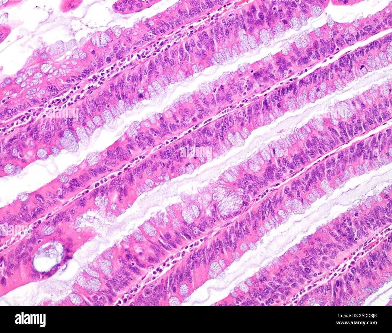 Villous Colon Polyp Light Micrograph This Specimen Shows Tissue From