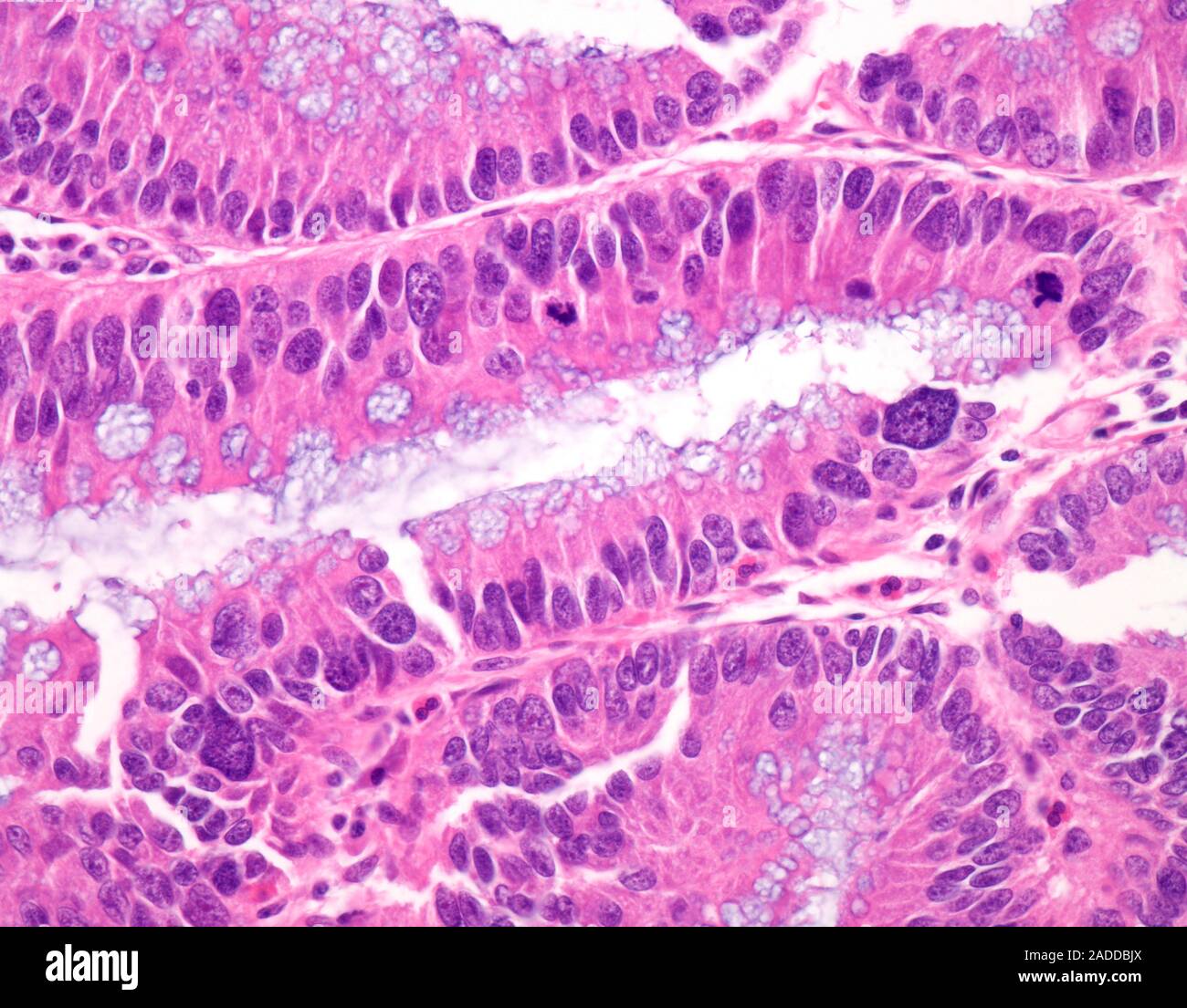 Villous colon polyp, light micrograph. This specimen shows tissue from ...