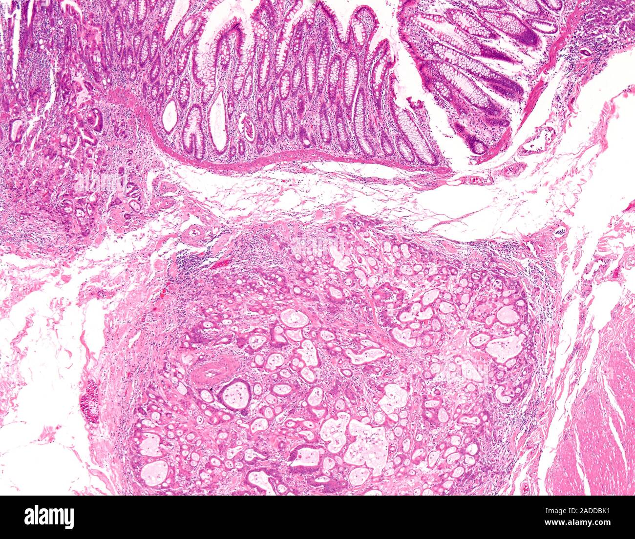 Colon cancer due to genetic mutation, light micrograph. This specimen ...